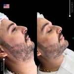 O que é mento no rosto? | Harmonização Facial | Dr. Fabio Barros | Rio ...