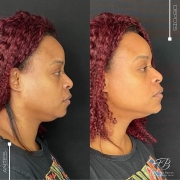 O que é mento no rosto? | Harmonização Facial | Dr. Fabio Barros | Rio ...