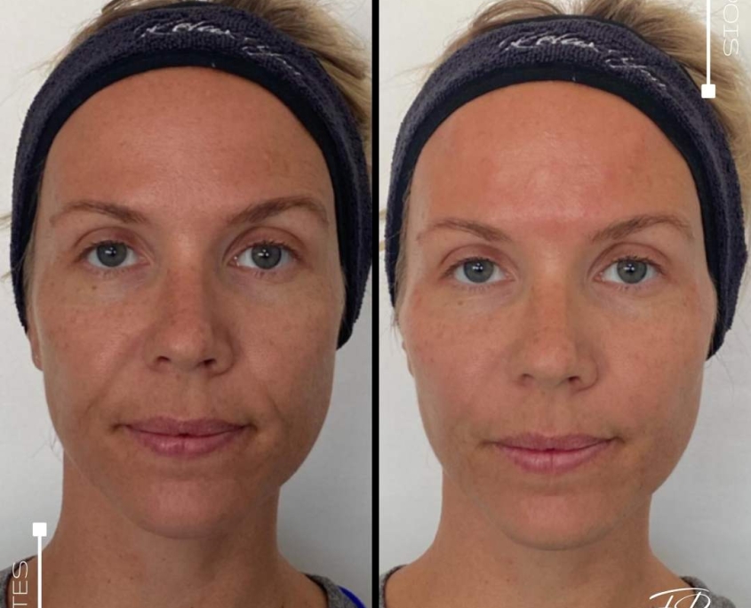 Full Face | Harmonização Facial | Dr. Fabio Barros | Rio de Janeiro e SP