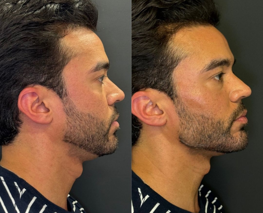 Preenchimento de Mandíbula | Harmonização Facial | Dr. Fabio Barros ...