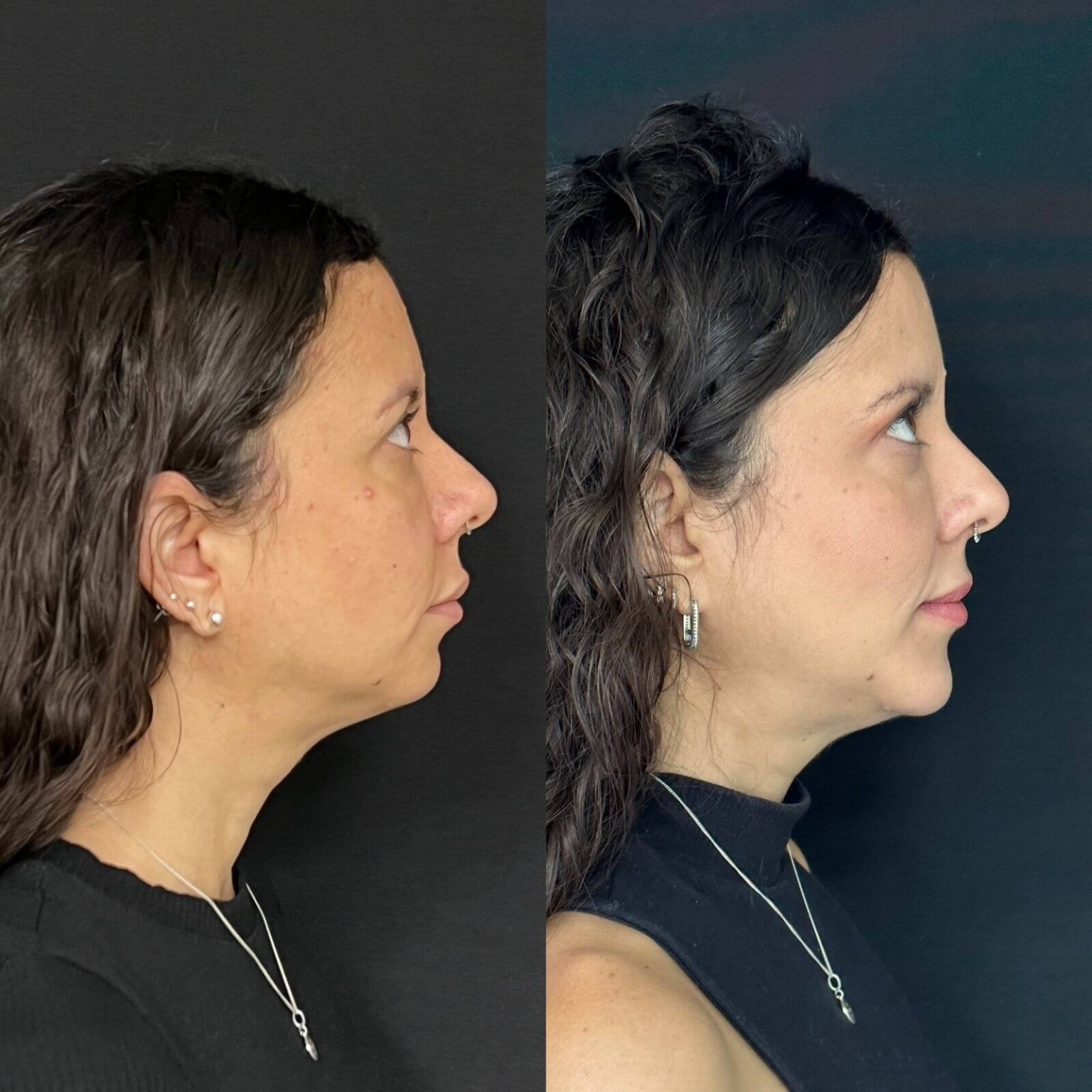 O que é mento no rosto? | Harmonização Facial | Dr. Fabio Barros | Rio ...