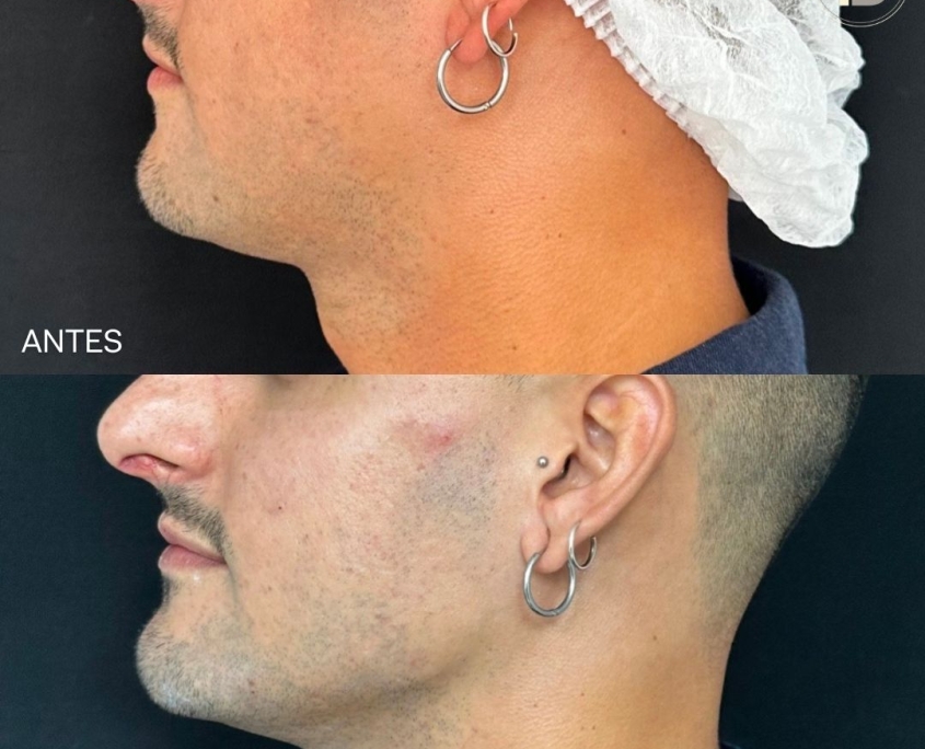 Preenchimento de Mandíbula | Harmonização Facial | Dr. Fabio Barros ...