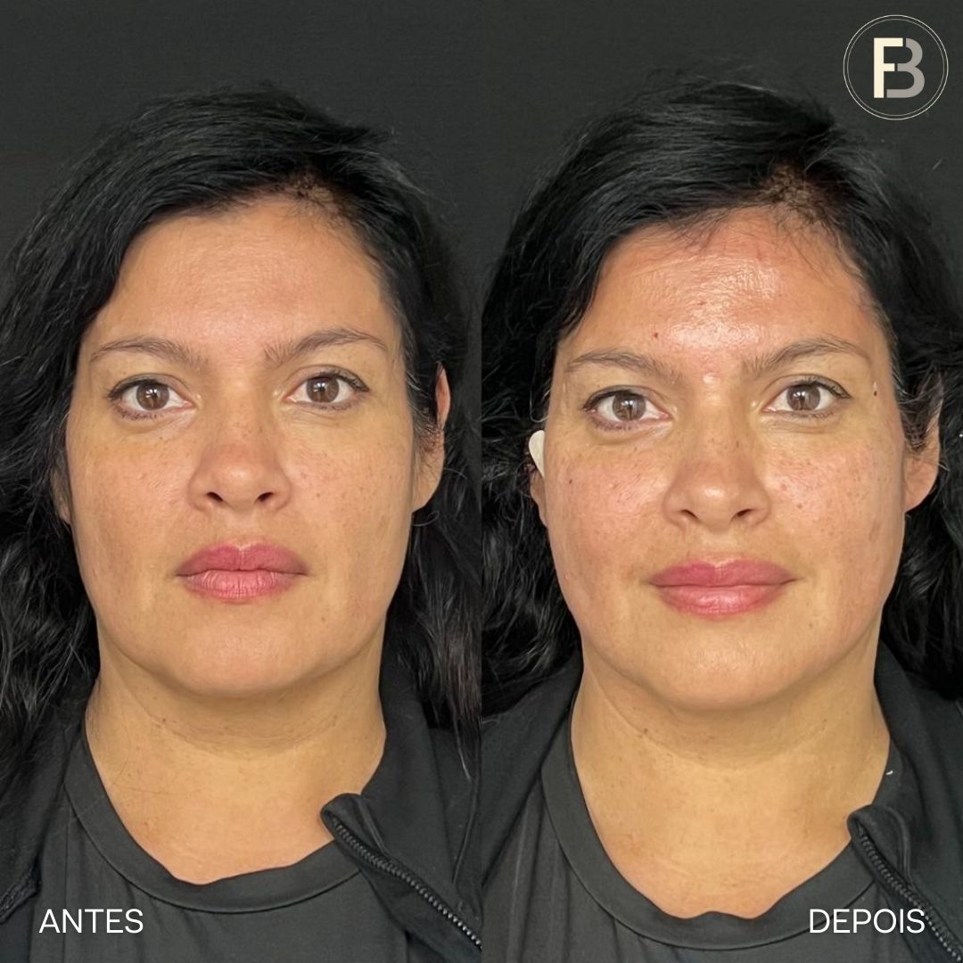 Fios de PDO | Harmonização Facial | Dr. Fabio Barros | Rio de Janeiro e SP