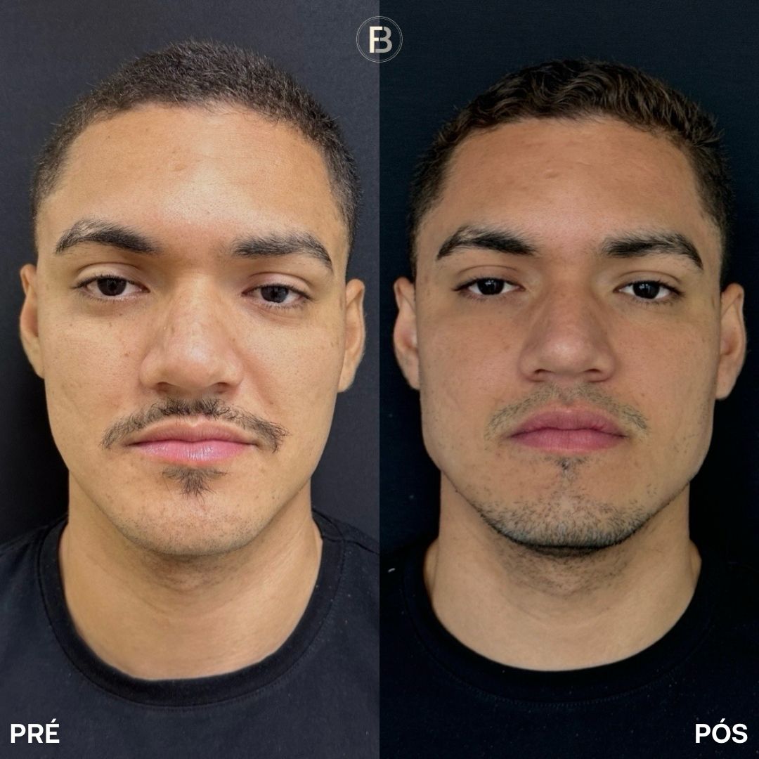 Preenchimento de Mandíbula